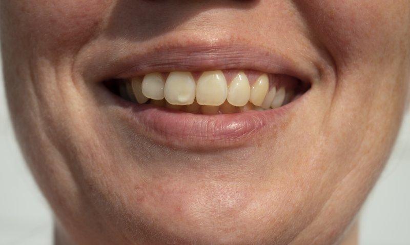 Dehydrated White Spots Teeth